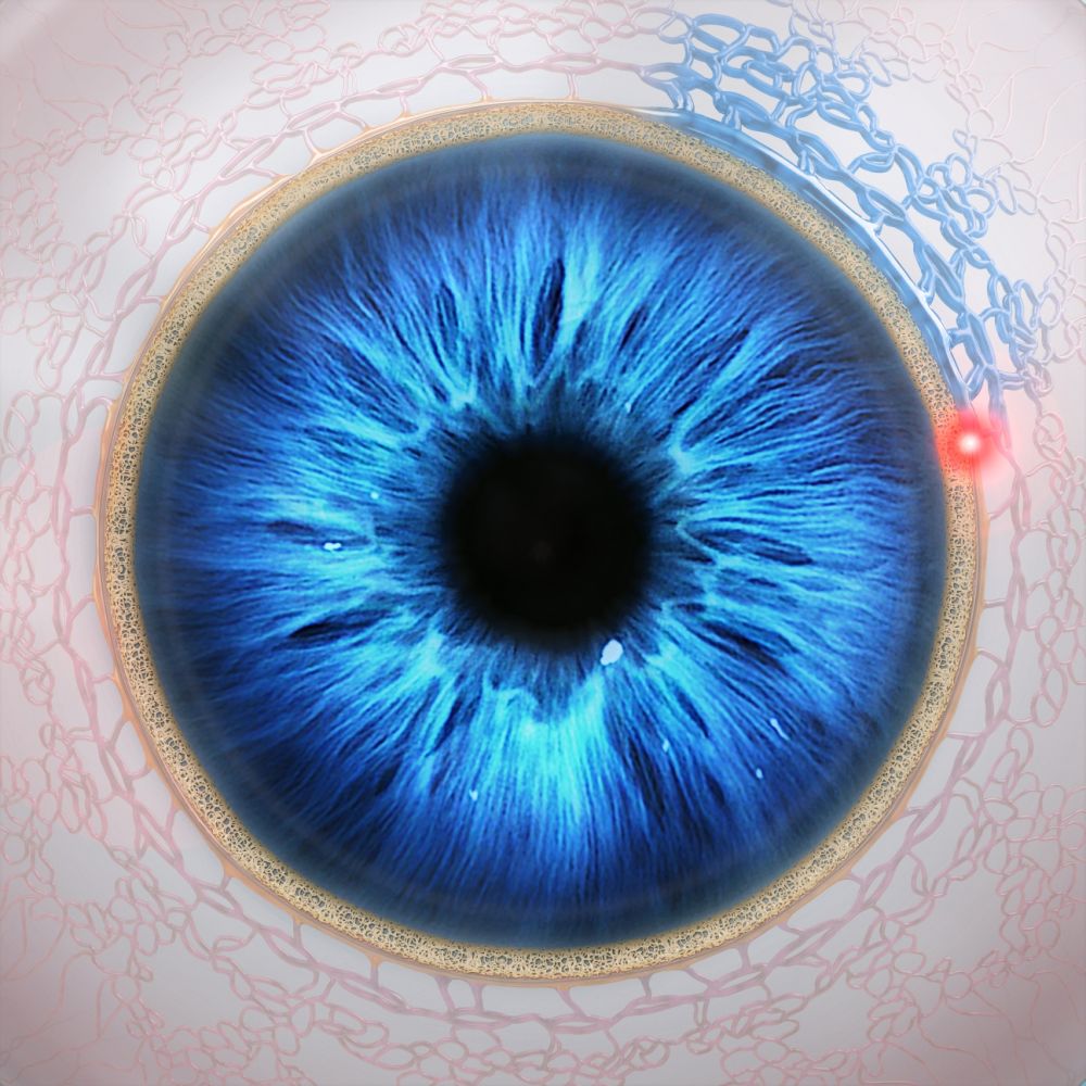 The original masterpiece of canaloplasty - Nova Eye Medical