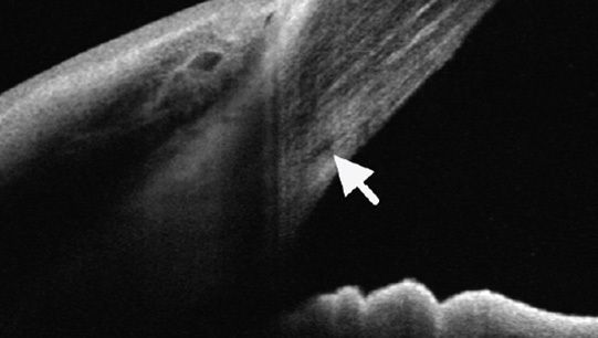 iTrack™ - Nova Eye Medical US