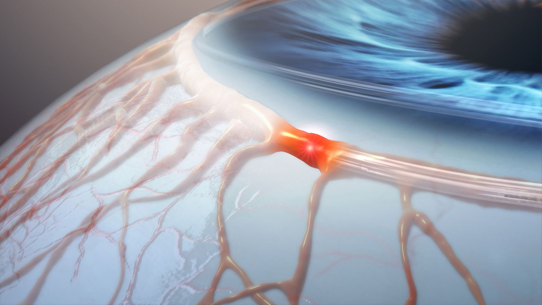 iTrack™ Advance - Nova Eye Medical